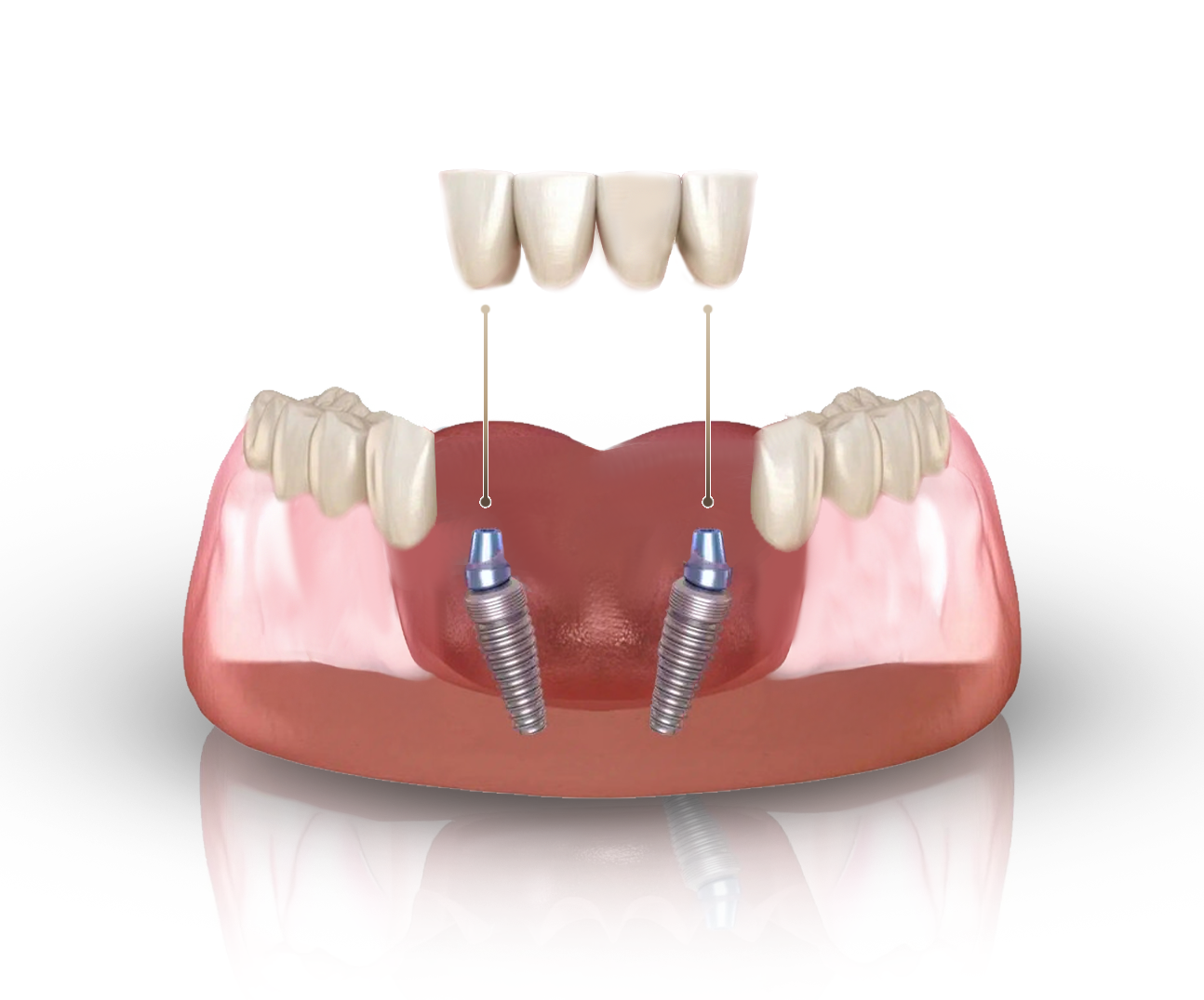Dental Implants in Dubai | Same Day & Permanent Solutions | Queens ...