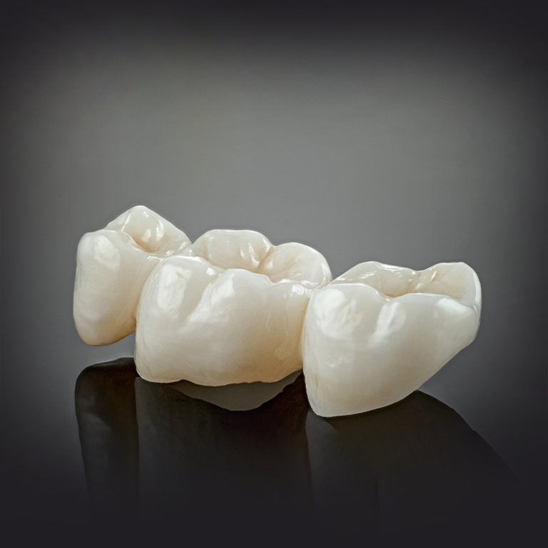 Dental Crowns & Bridges in Dubai | Restore Missing Teeth | Queens Elite ...