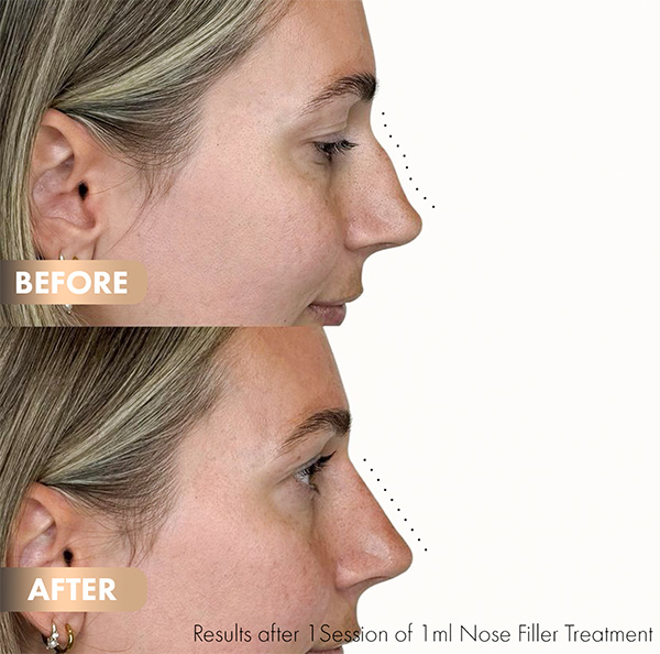 Professional Nose Fillers in Dubai | Queens Elite Medical