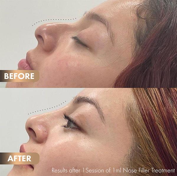 Professional Nose Fillers in Dubai | Queens Elite Medical