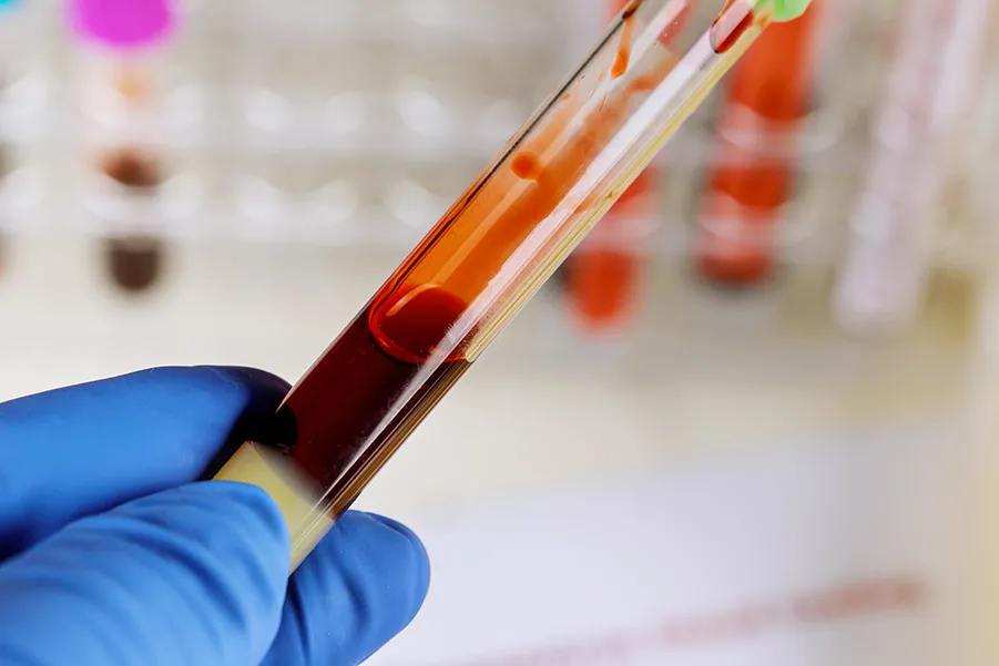 PRP Treatment in Dubai Marina | Platelet Rich Plasma Therapy